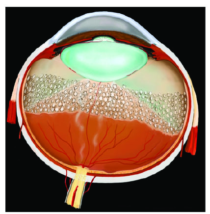 Understanding ROP - ROP Stages and Treatment - IRIDEX