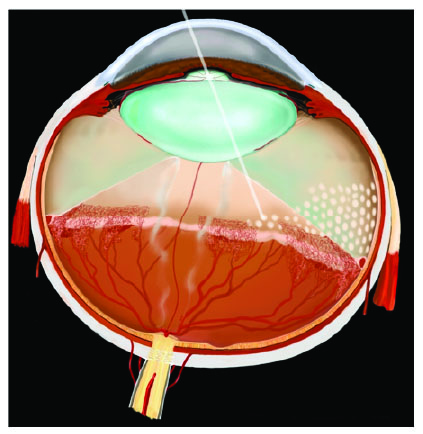 Understanding ROP - ROP Stages and Treatment - IRIDEX