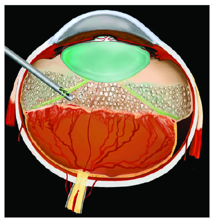 Understanding ROP - ROP Stages and Treatment - IRIDEX