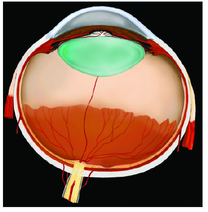 Understanding ROP - ROP Stages and Treatment - IRIDEX