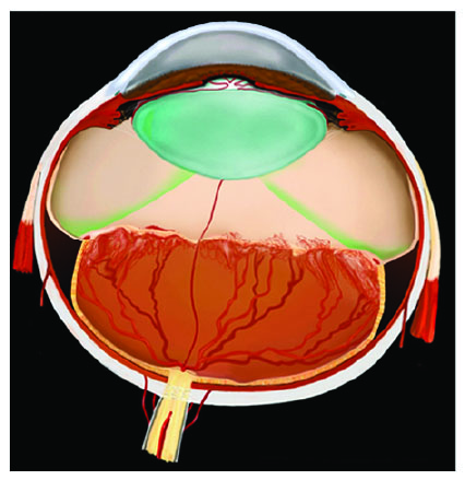 Understanding ROP - ROP Stages and Treatment - IRIDEX