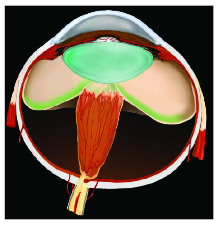 Understanding ROP - ROP Stages and Treatment - IRIDEX